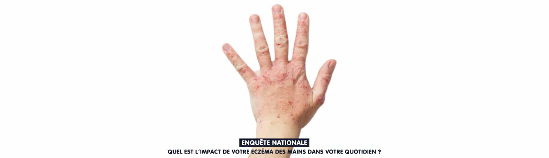 Association Française de l'Eczéma : comment mieux vivre avec l'Eczéma